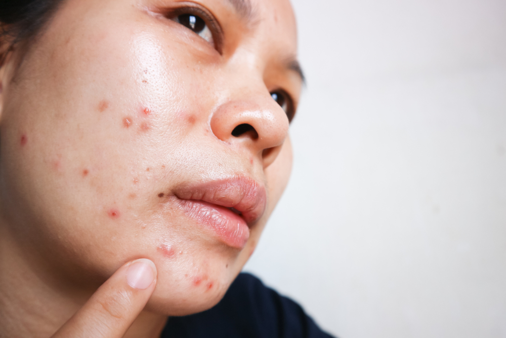 Best Acne Treatment in Acworth | Experienced With Proven Results