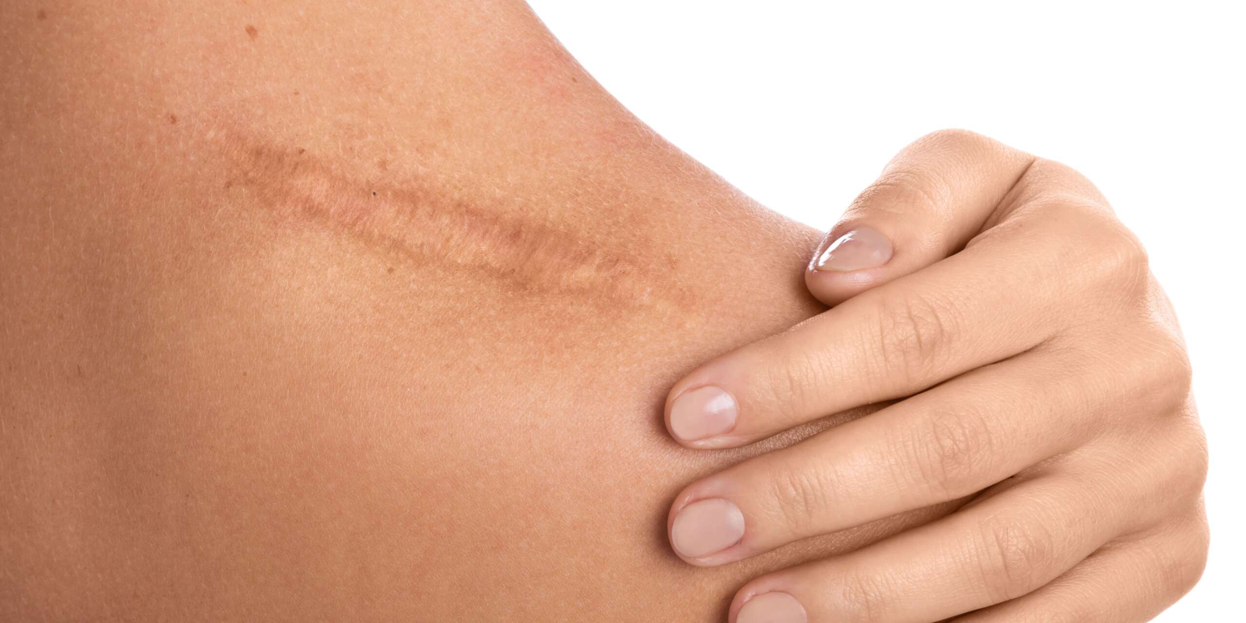 Best Keloid Doctor In Marietta Georgia - Acworth Dermatology